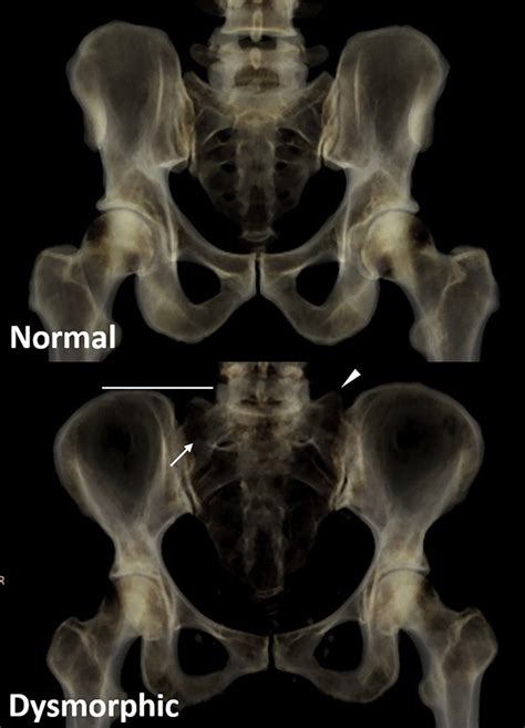 Examples Of Pelves With And Without Sacral Dysmorphism Note The Download Scientific Diagram