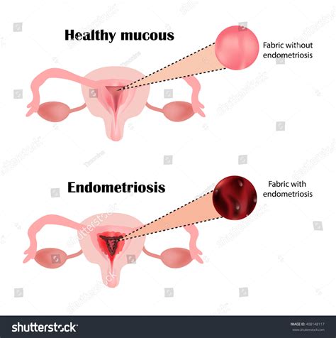 Endometriosis Structure Pelvic Organs Adenomyosis Endometrium Stock