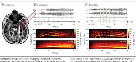 Figure 1 From Association Of Closed Loop Brain Stimulation Neurophysiological Features With