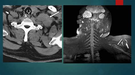 Imaging Of Brachial Plexus Radiology Pptx Pptx