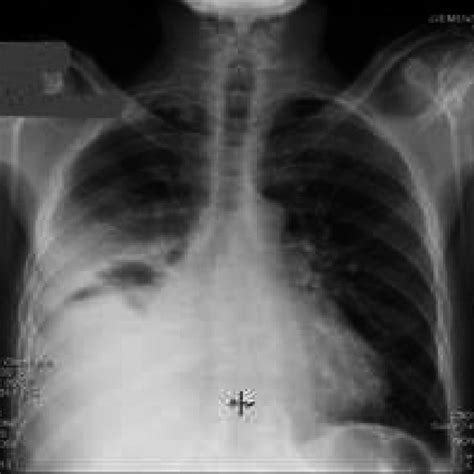 Quantitative Lung Perfusion Scan Of A Patient With Moderately Severe