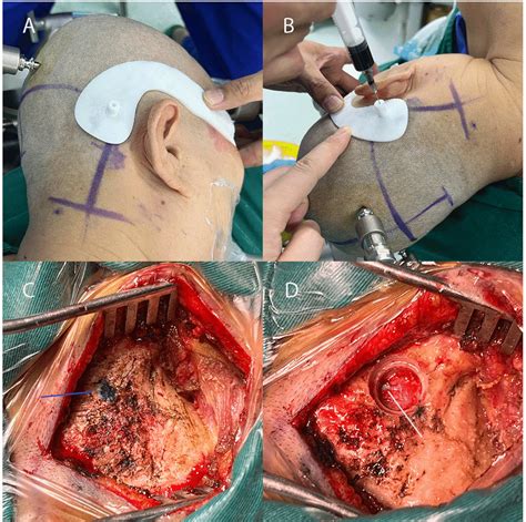 Application Of 3d Printing Technology In Microvascular Decompression
