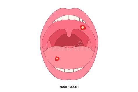 Oralpathology Stock Illustrations 5 Oralpathology Stock Illustrations