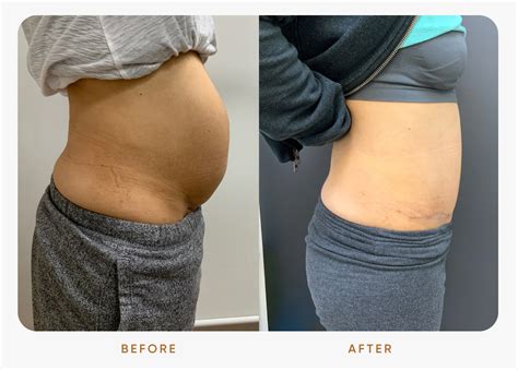 Tummy Tucks And Diastasis Recti Repair Form