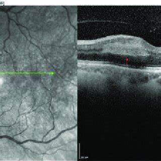 Heidelberg SD OCT Macular Scan Of Multiple Patches Of Inner Nuclear And