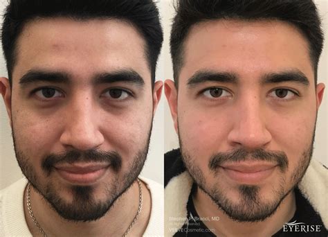 Benefits Of Combining Botox And Dermal Fillers Best Practices For A