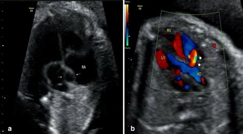 Apical Four Chamber View In Fetal Echocardiography Showing Circular