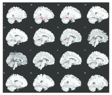 Sagittal Slices Illustrating Grey Matter Regions Showing Download