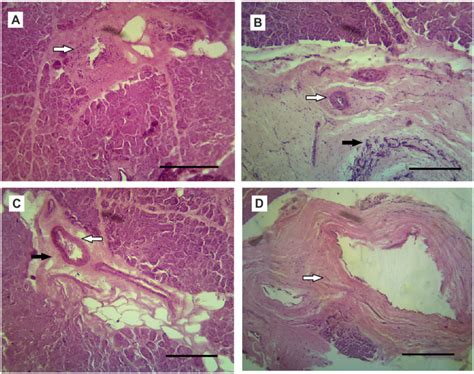 Histopathology Of Pancreas With Eurytrematosis A Infiltration Of