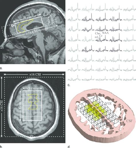 A Sagittal And B Axial T1 Weighted Magnetic Resonance Mr Images