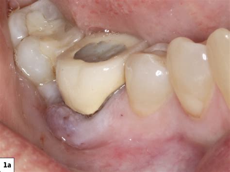 Socket Grafting And Implant Placement A Simplified Approach