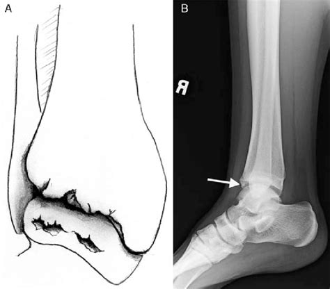 Osteophytes Treatment