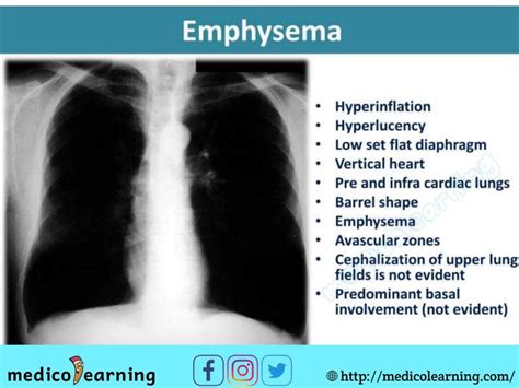 Chest X Ray Emphysema