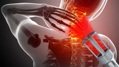 Everything You Need To Know About Class Iv Laser Therapy