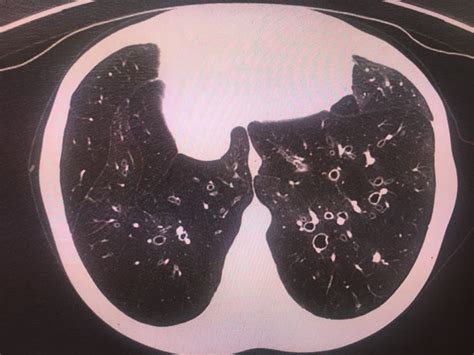 Signet Ring Sign In Bronchieactasis