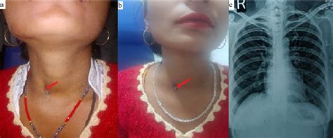 Sternocleidomastoid Muscle Swelling