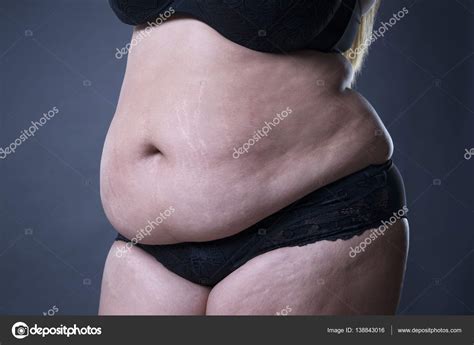 Pictures Stretch Marks On Stomach Fat Female Belly Stretch Marks