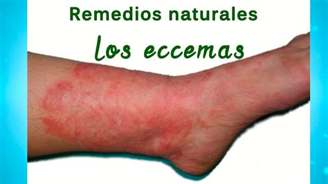 Los Eccemas Remedios Naturales Para Tratralos Youtube