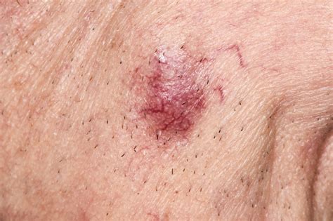 Case Report Unusual Combined Merkel Squamous Cell Carcinoma In Situ