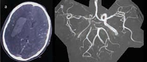 Noncontrast Computed Tomography Ct Scan Showing A Large Download Scientific Diagram