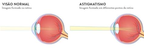 Você sabe a diferença entre miopia e astigmatismo Lenscope