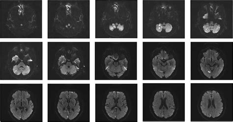 Mri Brain Demonstrating Multifocal Acute Infarcts On Diffusion