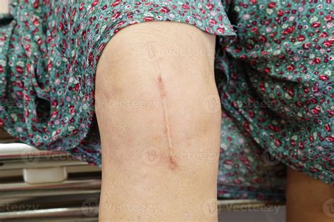 Asian Elderly Woman Patient With Scar Knee Replacement Surgery In