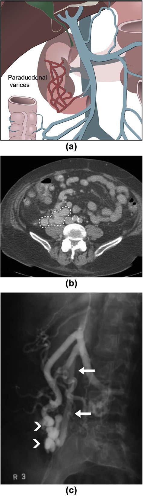 Portal Hypertension A Review Of Portosystemic Collateral Pathways And