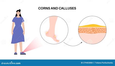 Callus And Corns Stock Vector Illustration Of Infographic 279403800
