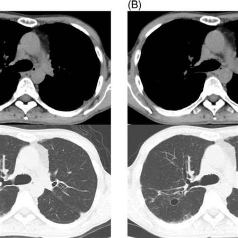 Chest Computed Tomography Ct Shows A Lung Nodule And A Calcified