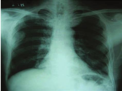Chest X Ray Pa View Showing A Lytic Lesion Over The Lateral Portion