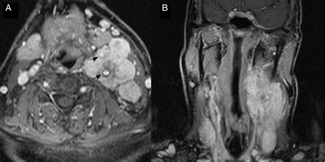Paraganglioma Carotídeo Maligno A Propósito De Un Caso Radiología