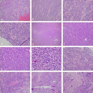 Histopathology Consistent With High Grade Glioma With Variable Cellular