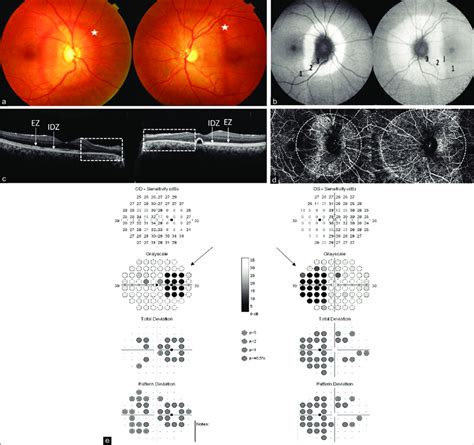 A Color Fundus Photograph Ou Showing Orange Yellow Colored