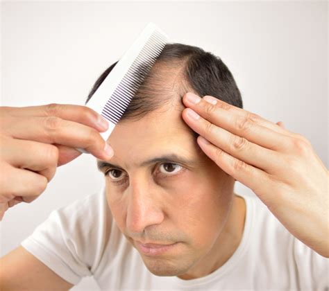 Hair Transplant Paul C Dillon Md Inc Schaumburg Il 60173