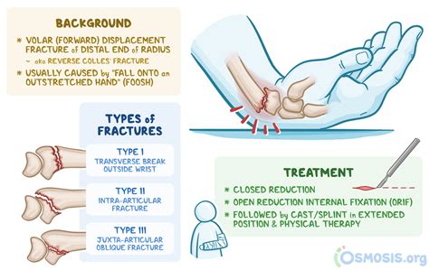 Distal Radius Fracture Splint Uk Pre Ids Deutschlandde
