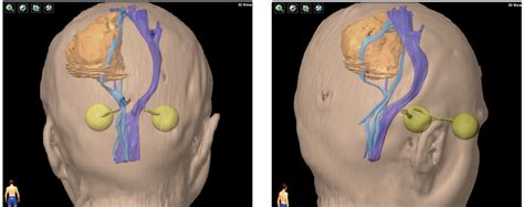 Reconstruction Of Corticospinal Tract Cst Adjacent To Gioma Splaying