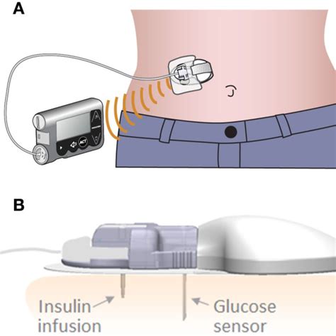 Continuous Glucose Monitoring Devices Medtronic At Gabrielle Miller Blog