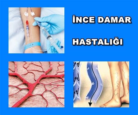 Kılcal Damar Tıkanıklığı Nedir Bilgiustam