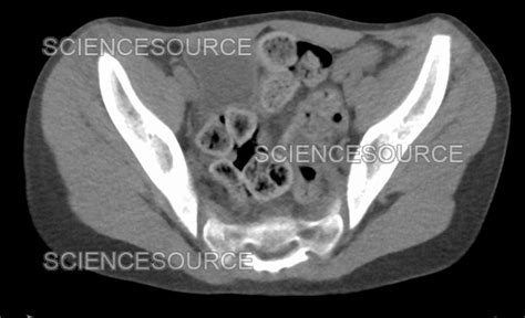Constipation In 12 Year Old Ct Scan Stock Image Science Source Images