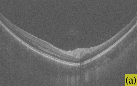 Retinal Boundary Segmentation A B Scan Image Denoised With