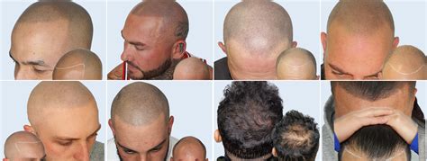 Sydney Scalp Master Hyper Realistic Hair Follicles 💯 Unnoticeable And