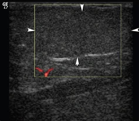 Ultrasound And Doppler Us In Evaluation Of Superficial Soft Tissue Lesions Journal Of Clinical
