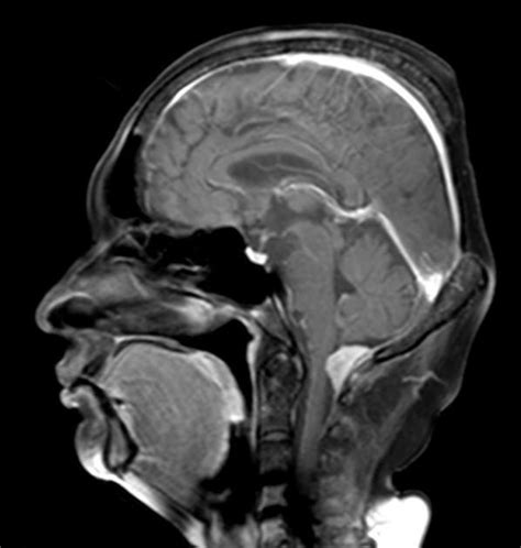 Dural Tail Zeichen Pacs