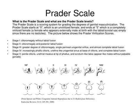 Ppt Prader Scale Powerpoint Presentation Id6016486