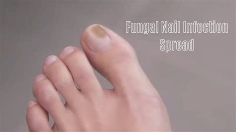 Fungal Nail Infections Archives Pathway Medicine