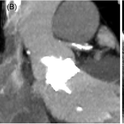Preoperative Computed Tomography Angiography And Transesophageal