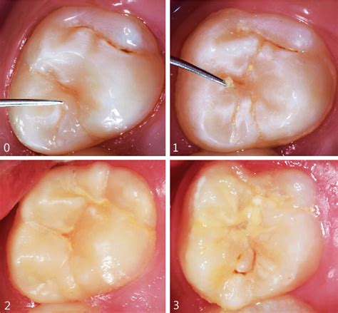 Figure 2 From Occlusal Caries Biological Approach For Its Diagnosis