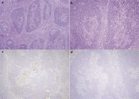 Histopathological Findings In 29 Lymph Node Biopsies With Increased