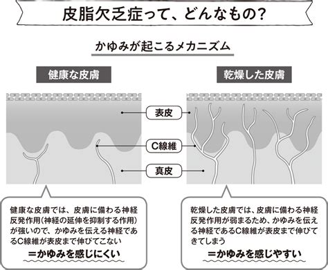 高齢者の「薬」＆生活への影響【皮脂欠乏症（ドライスキン等）治療薬】 【へるぱる】訪問介護をサポートする情報誌